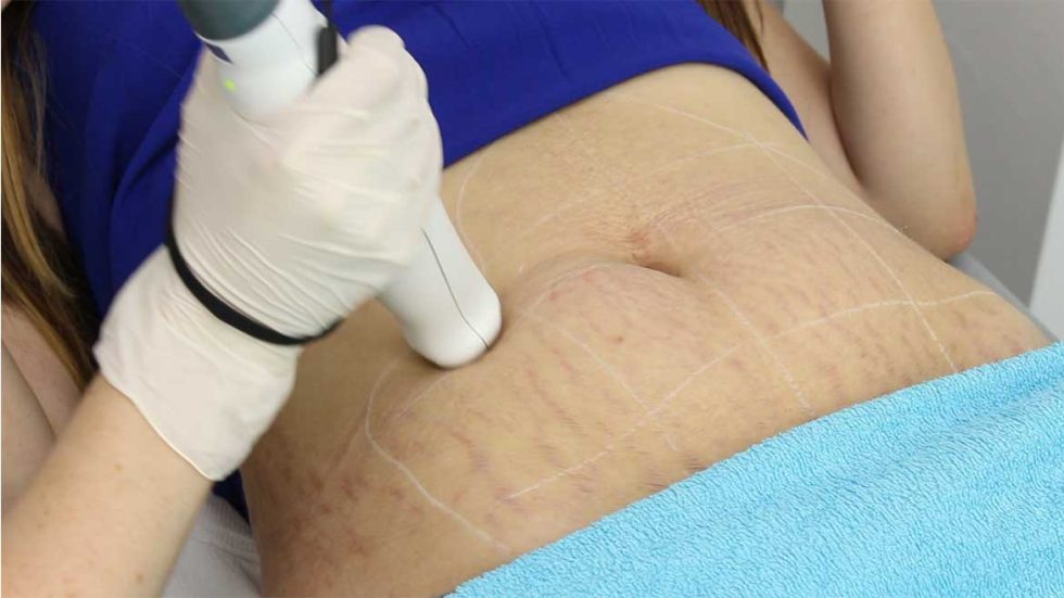 Stretch Mark Laser Treatment | Wymore Laser & Anti-Aging