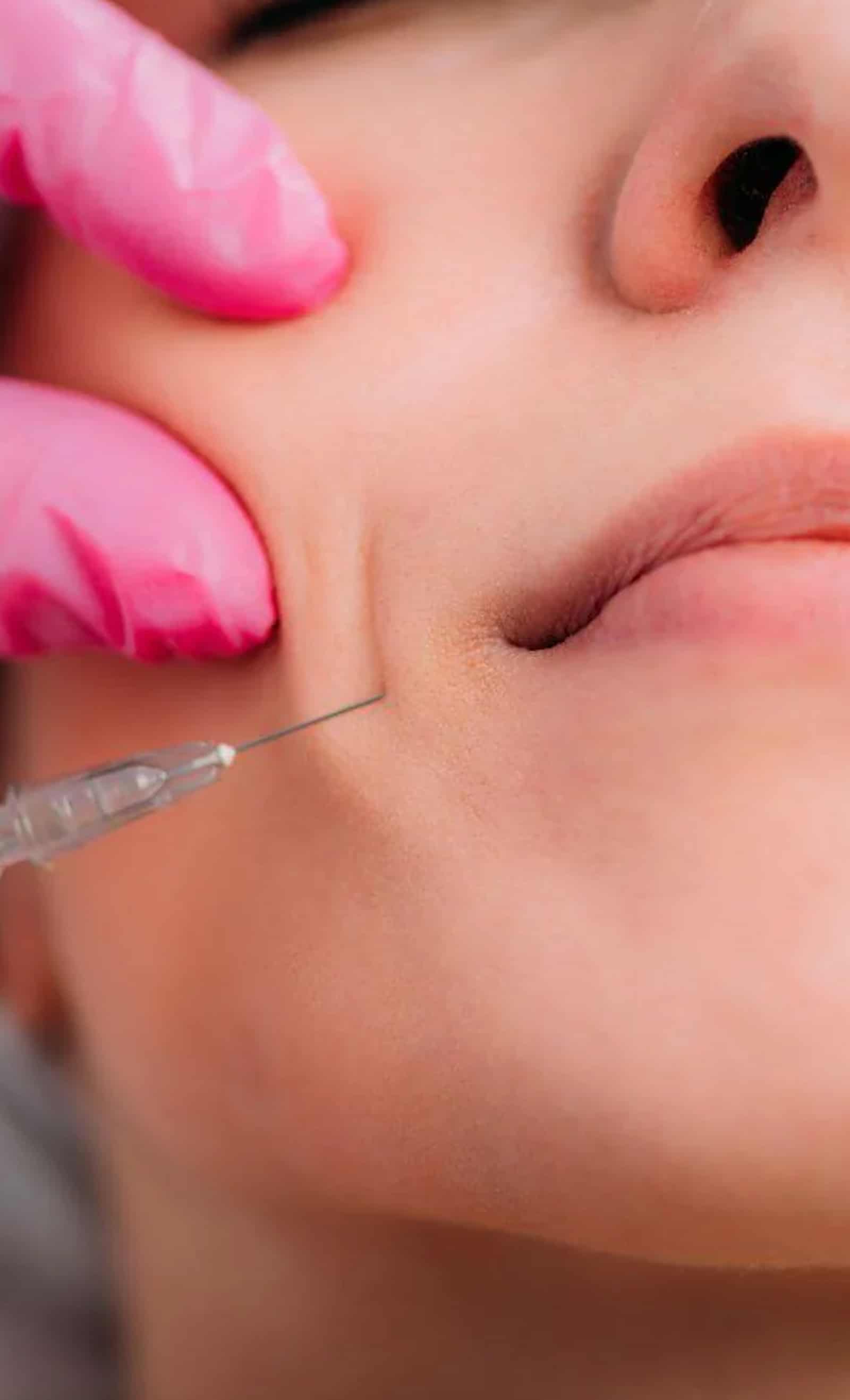 Nasolabial Fold Fillers in Winter Park, FL | Wymore Laser