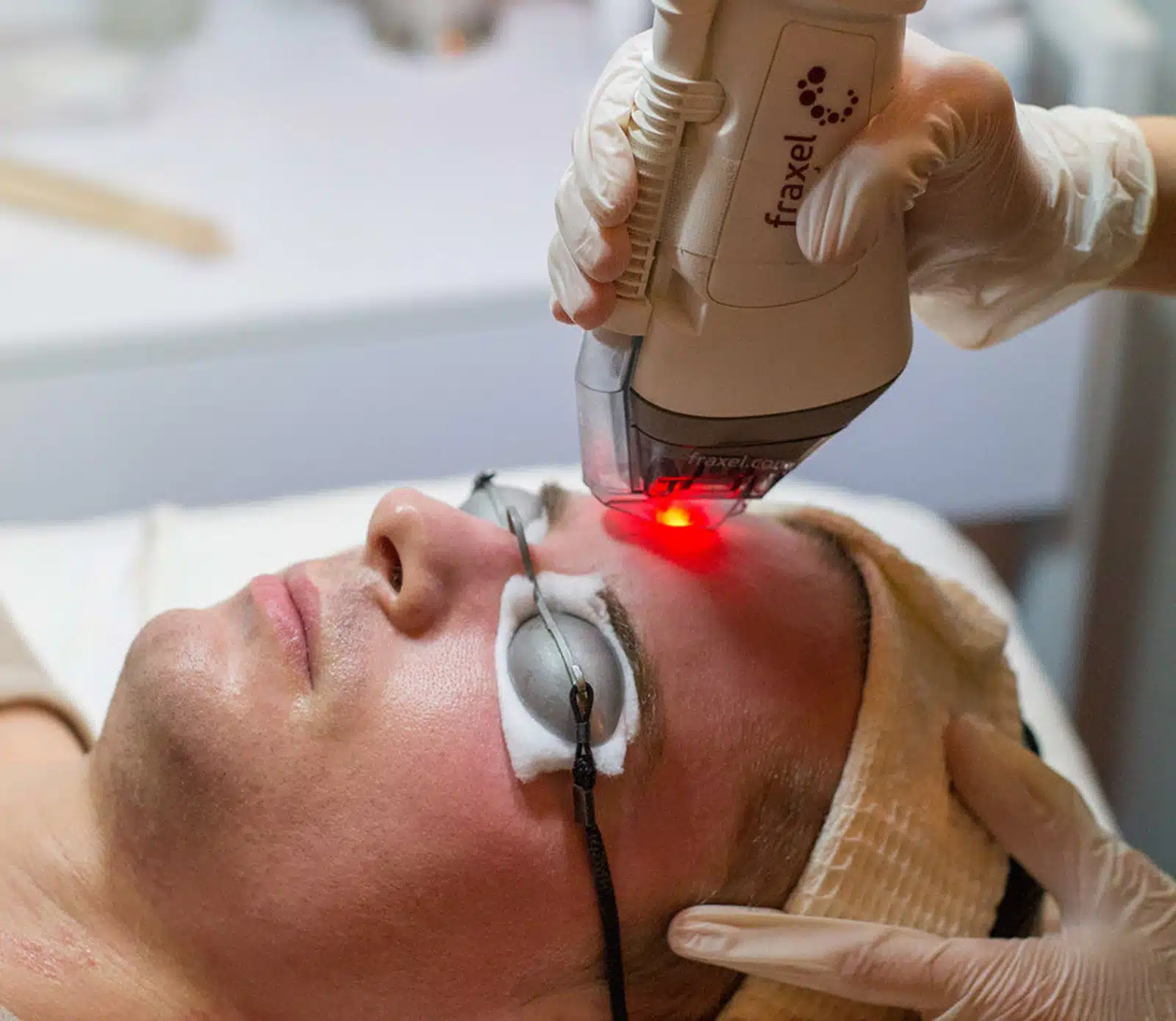 Fraxel Laser Orlando – Advanced Skin Rejuvenation